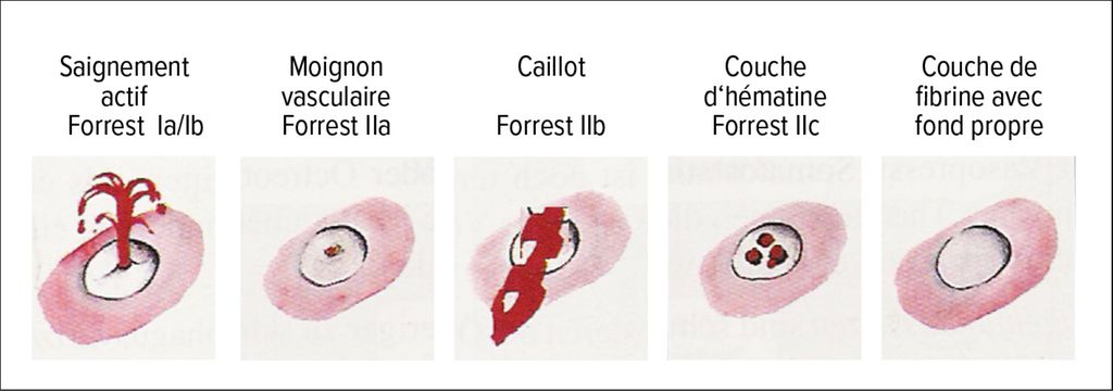 Maladie ulcéreuse gastroduodénale - Contenu en francais - Universimed - Medizin im Fokus